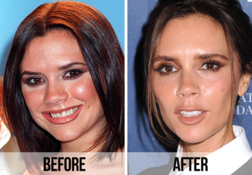 10 Celebrities with Bad Teeth (With Before and After Pictures)